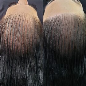 Our clients ️ it | Before & After Scalp Micropigmentation for women