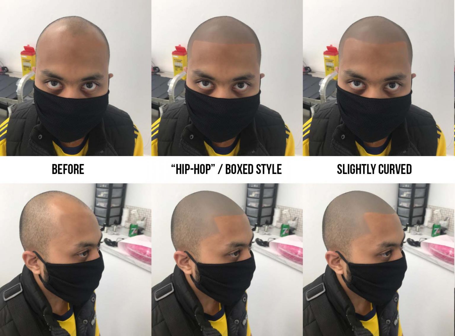 MIRACLE Hairline Recovery in Birmingham UK | Hair Tattoo (SMP) for ...