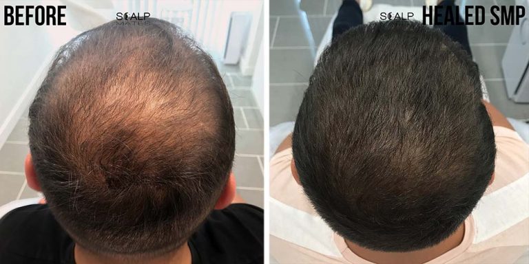 Scalp Micropigmentation SMP for Long Hair in Birmingham UK | Results ...