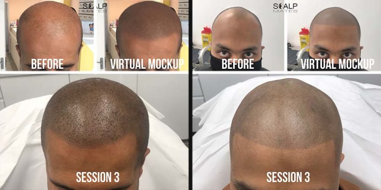 Realistic Hairline Tattoo | Scalp Micropigmentation SMP for Short ...